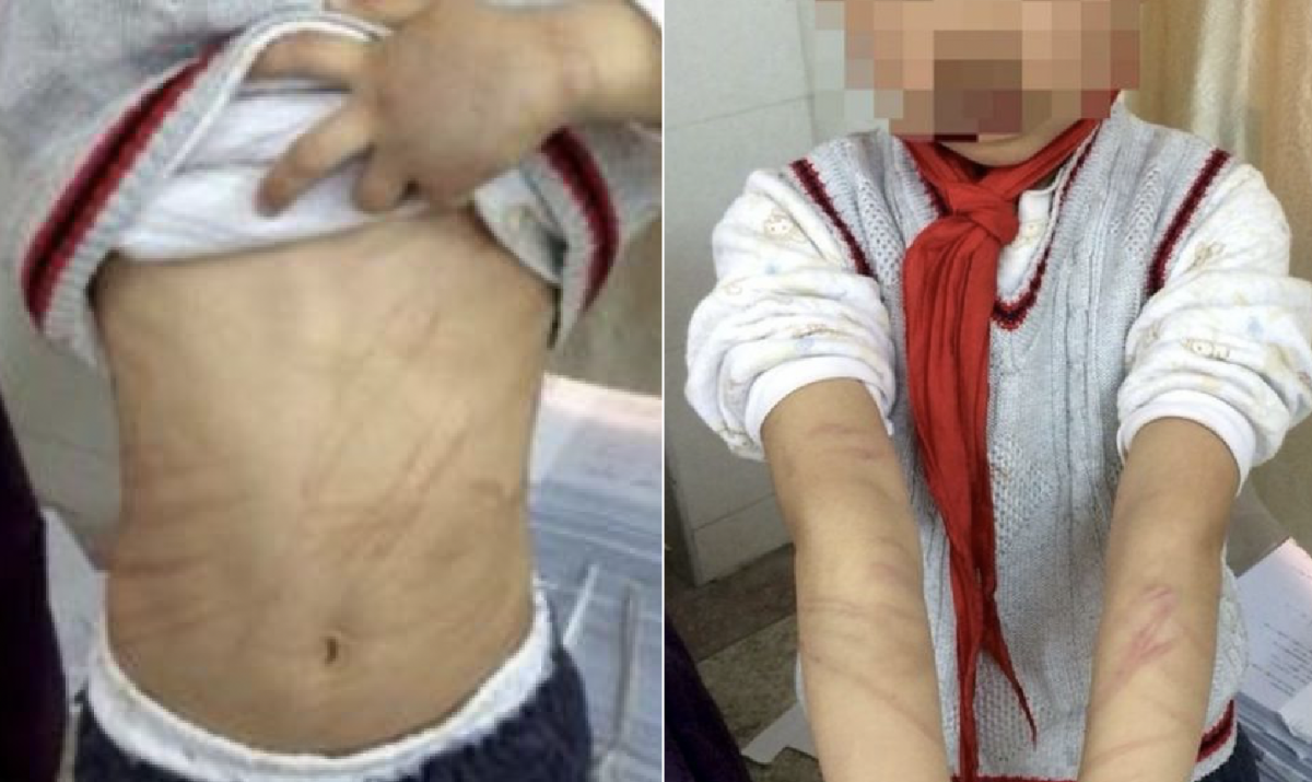 Teachers find these marks on 9-year-old student, are horrified to ...